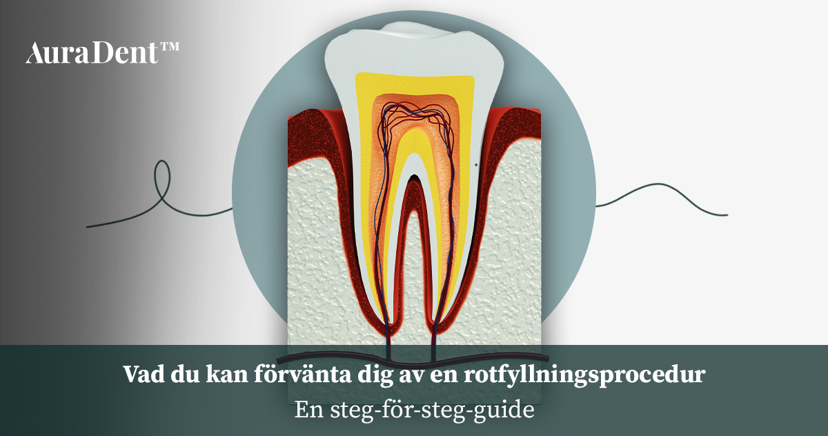 Rotfyllning steg för steg: Komplett guide till rotbehandling
